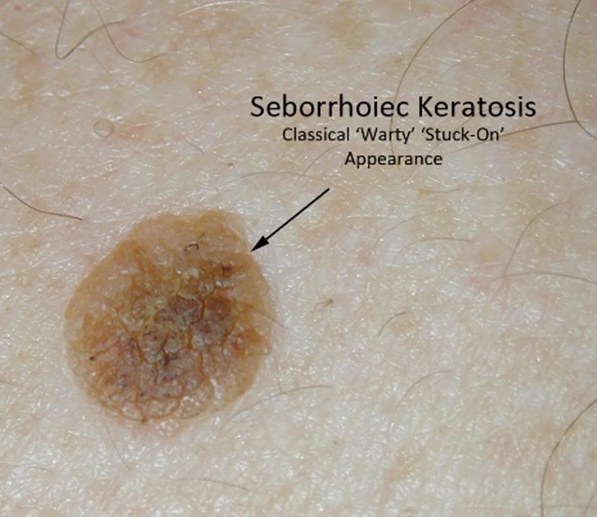 Seborrheic Keratosis Fact Sheets Yale Medicine Estrich Mobil